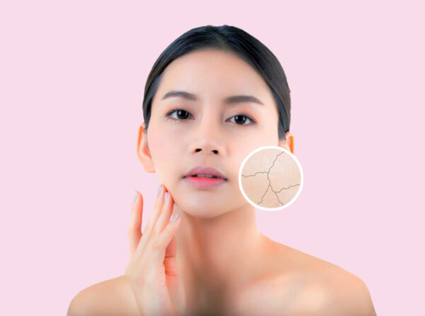 Dry Skin Facial Treatment - Esthetic Rosereve
